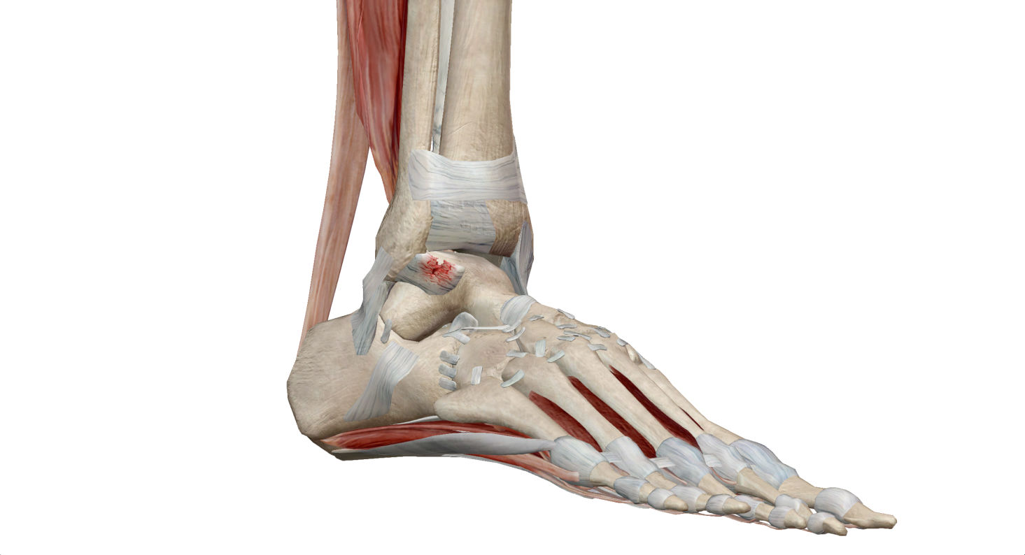 Entorse de la cheville